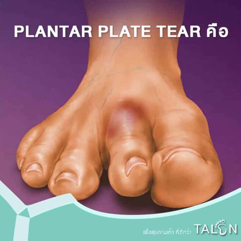 PLANTAR PLATE TEAR คือ